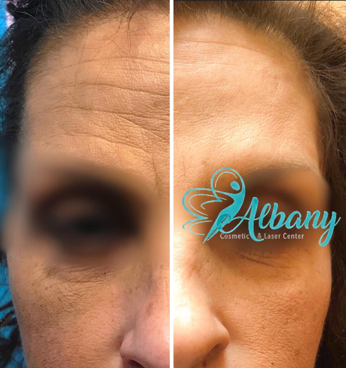 Botox Microdroplet Injection Case No. 1098 Albany Cosmetic and Laser ... Botox Microdroplet Injection Case No. 1098 Albany Cosmetic and Laser ...