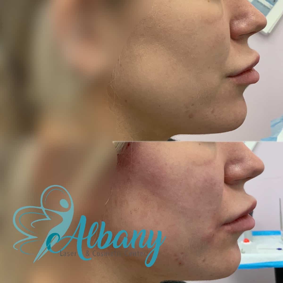 Cheek thread lift Case # 1105 | Albany Laser & Cosmetic Medical Spa in ...