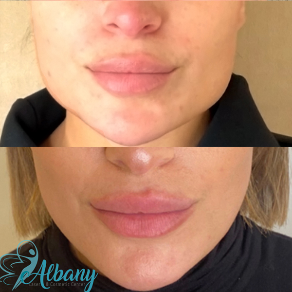 Botox Face Slimming Edmonton | Masseter Injections for TMJ