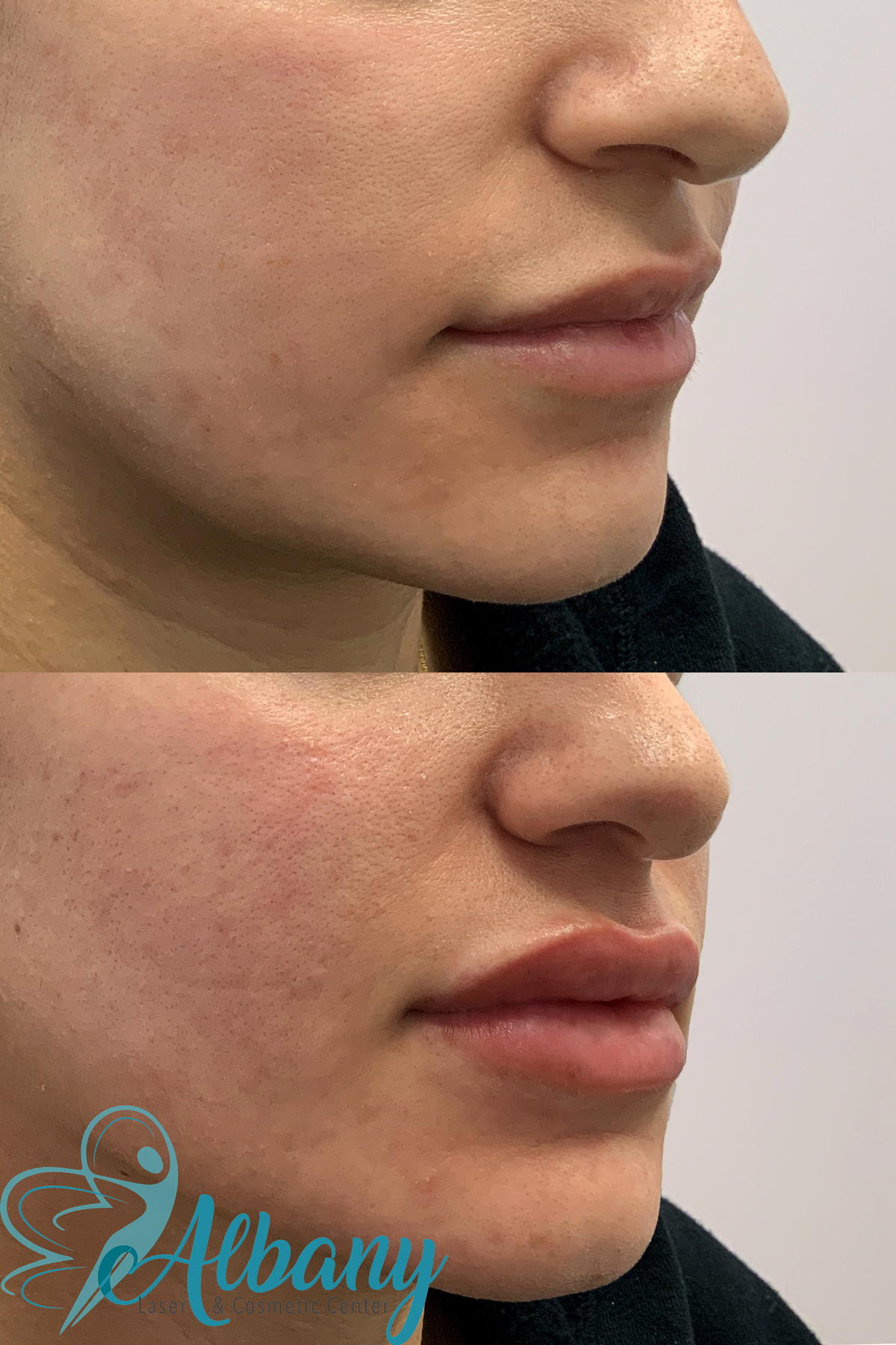 Lip injections: Case No. 1339 Albany Cosmetic and Laser Centre Edmonton