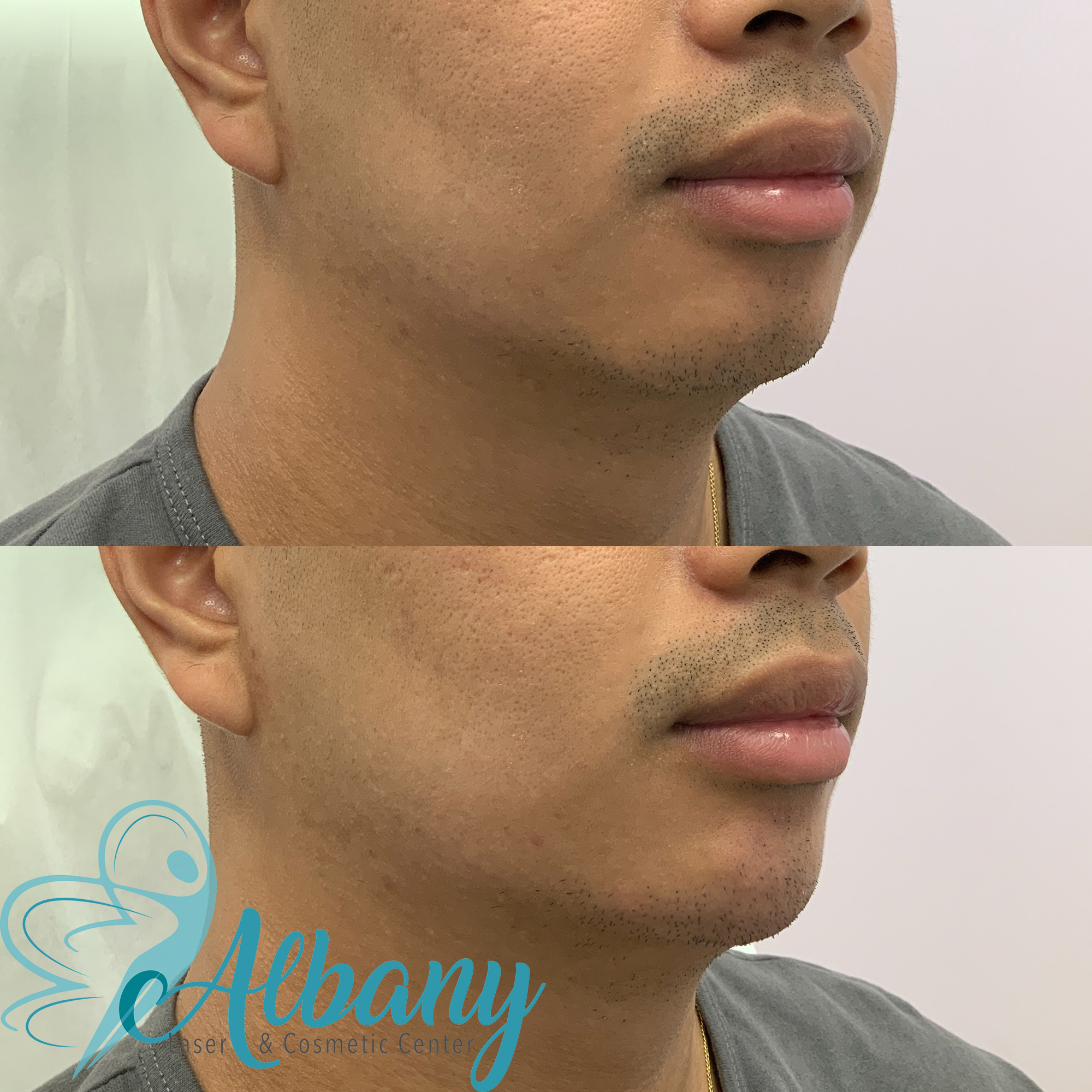 Chin fillers in Edmonton: Case No. 1367 Albany Cosmetic and Laser ...