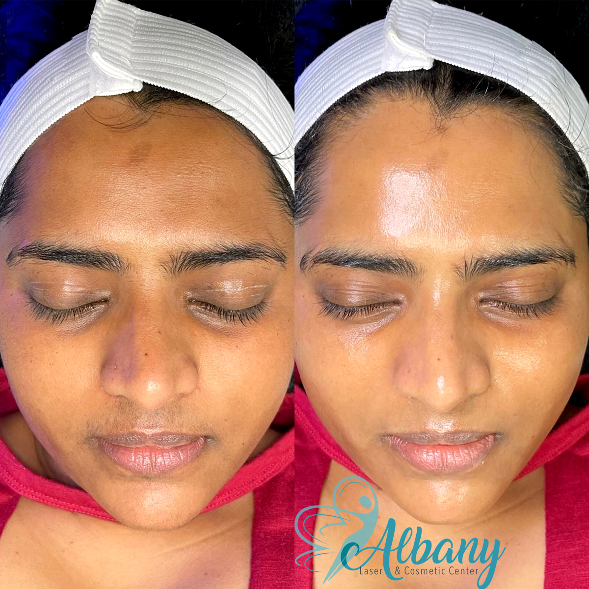 Blackheads and whiteheads | Albany Cosmetic and Laser Centre Edmonton